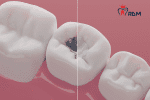Amalgam VS Composite Fillings: Choosing The Right Dental Restoration